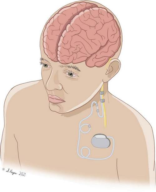 NeuroPace (NPCE) | IPO 2021