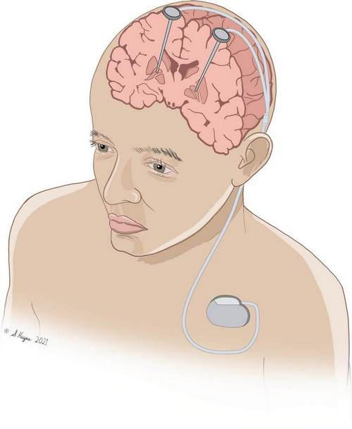 NeuroPace (NPCE) | IPO 2021